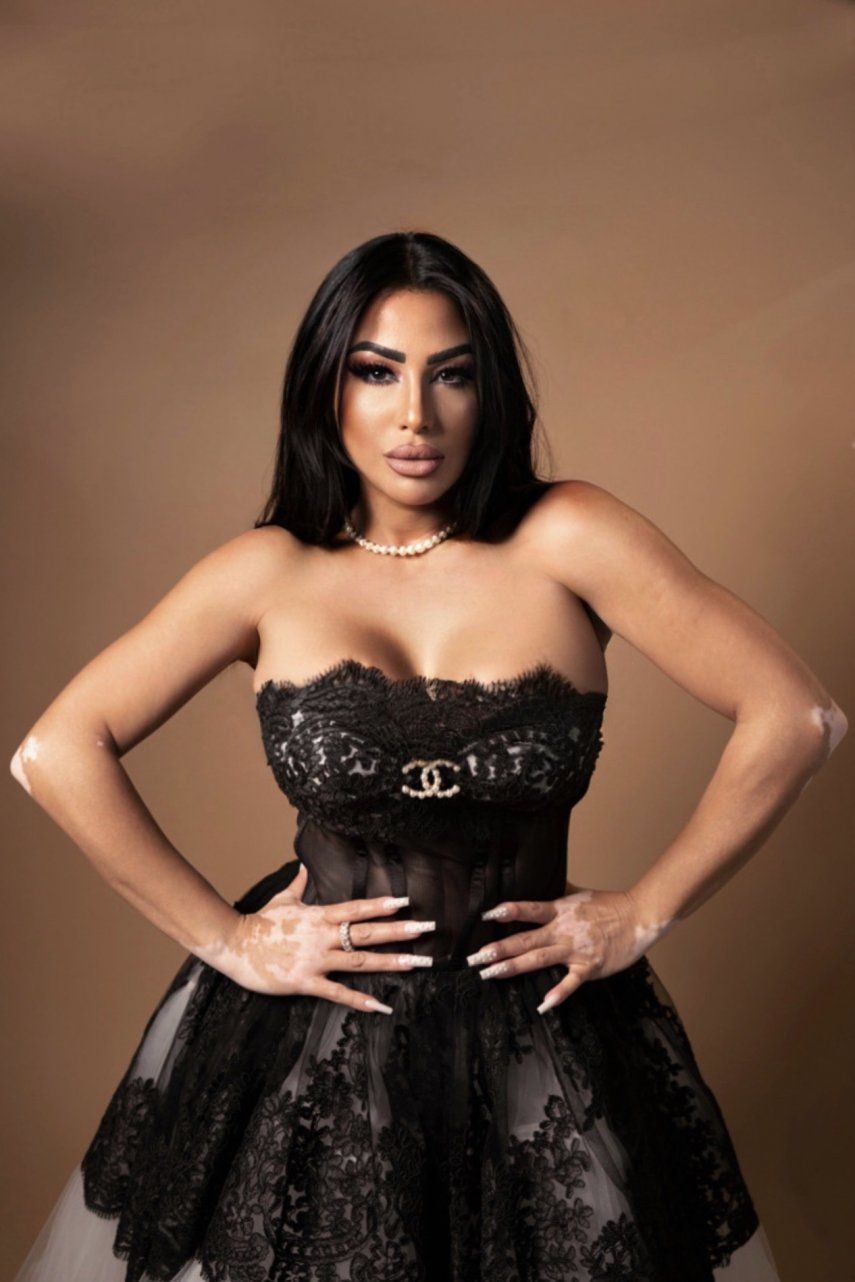 Sandra Iracema, la influencer cubana que reivindicó el vitíligo