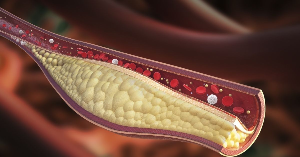 La aterosclerosis acelera el envejecimiento de los jóvenes