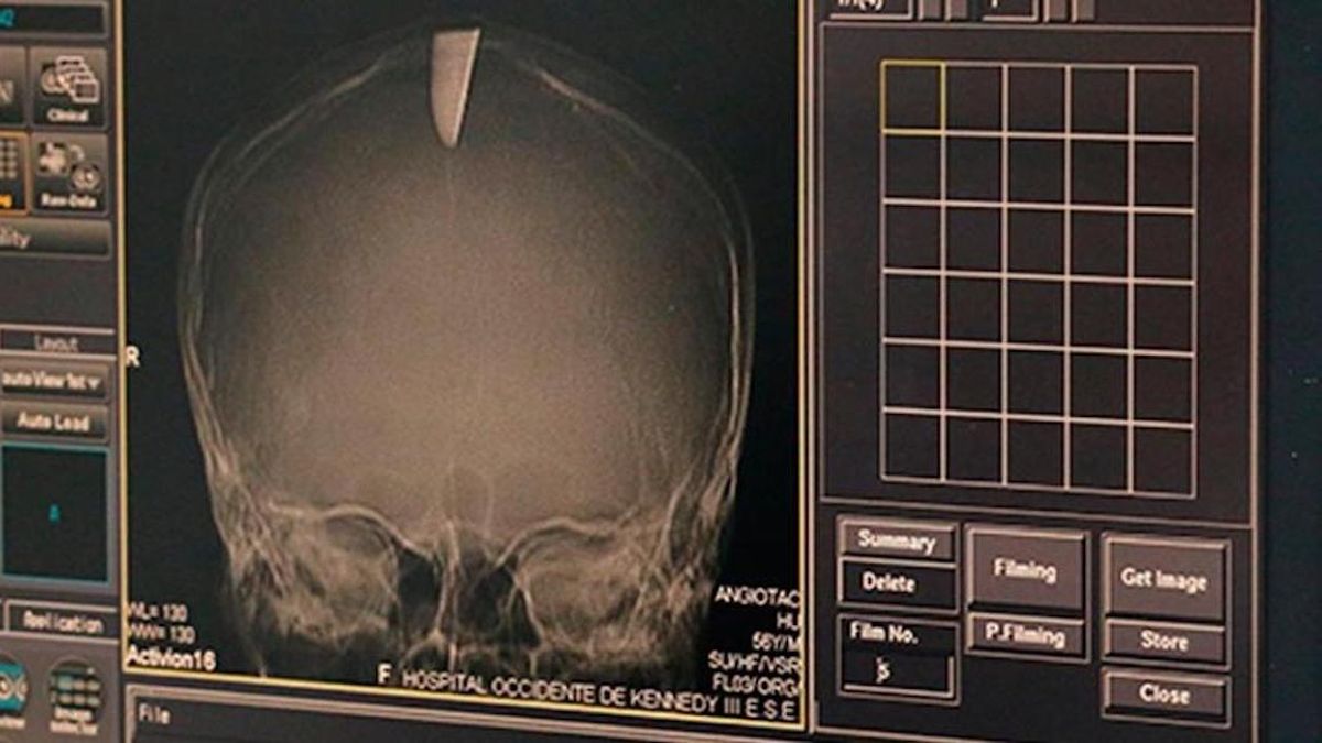 Un hombre caminó con un cuchillo incrustado en la cabeza en busca de ayuda